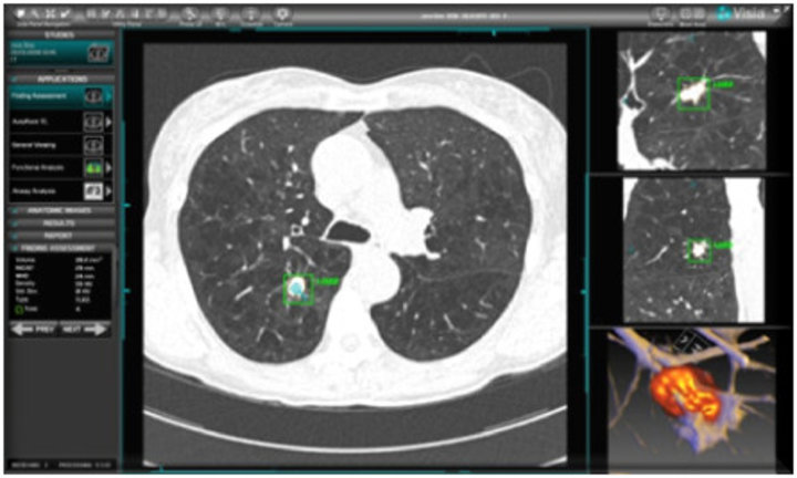 MeVis Medical Solutions AG: Lung