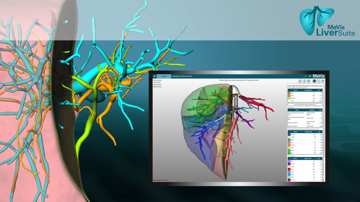 MeVis Medical Solutions AG: MeVis Liver Suite