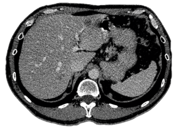 MeVis Medical Solutions AG: Liver